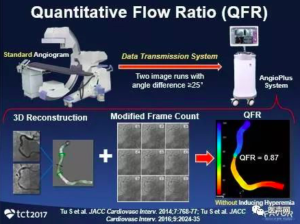 TCT 中国之声｜徐波：FAVOR II研究证实QFR与FFR具有较高的诊断一致性 -- 严道医声网