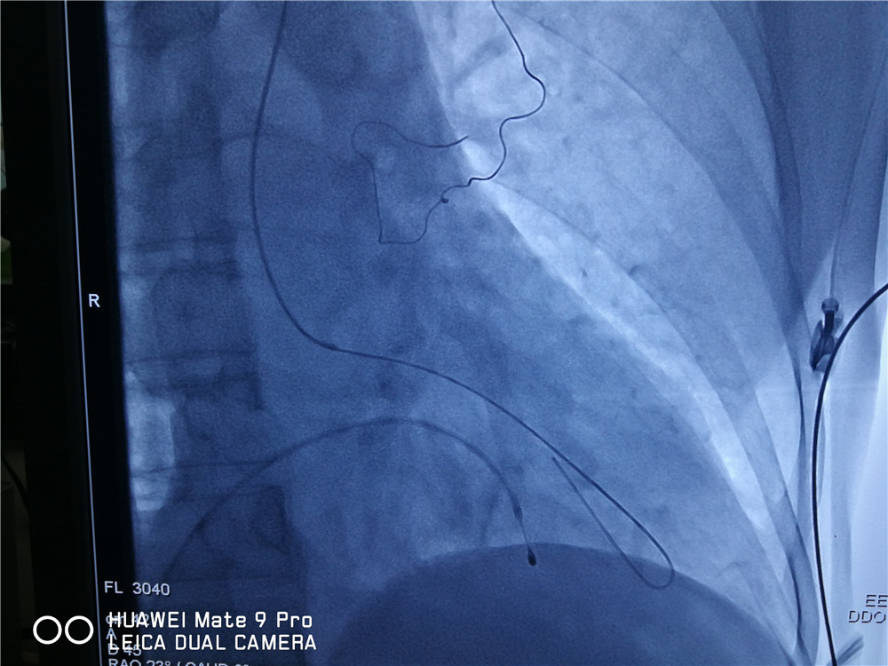 葛均波院士做客“白求恩讲堂”并携手罗建方团队完成华南首例经颈动脉TAVI -- 严道医声网