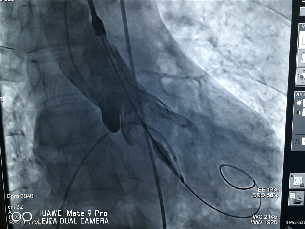 葛均波院士做客“白求恩讲堂”并携手罗建方团队完成华南首例经颈动脉TAVI -- 严道医声网