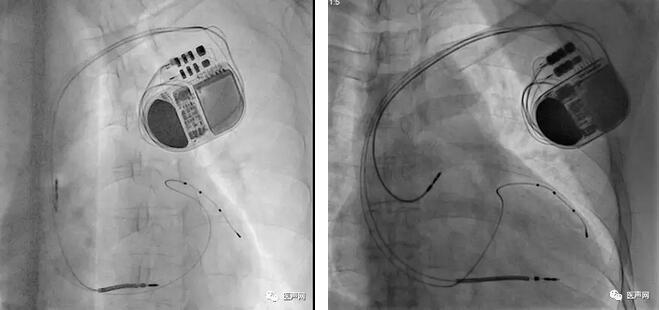 病例分享｜浙江省首例兼容核磁共振全身扫描+DF4+IS4 CRT-D系统成功植入 -- 严道医声网