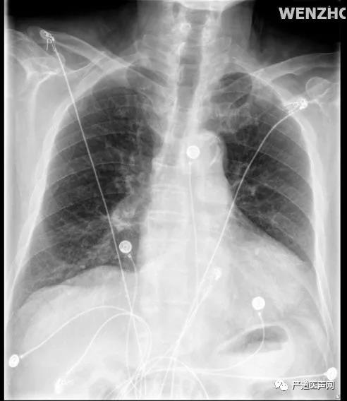 病例分享｜真实再现国际原创新技术快速实现心脏再同步治疗 -- 严道医声网