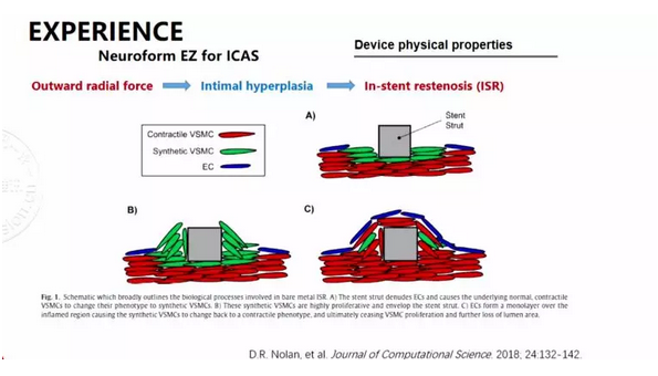 NEIMS 2018｜王君：Neuroform EZ 支架在症状性颅内动脉狭窄中的初步应用 -- 严道医声网