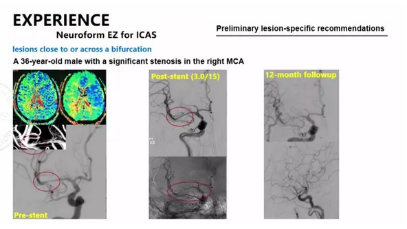 NEIMS 2018｜王君：Neuroform EZ 支架在症状性颅内动脉狭窄中的初步应用 -- 严道医声网