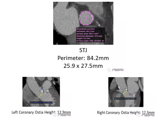 CSI AP 2019 | Live Case：陈茂教授团队应用“华西经验”成功演示一例TAVI手术 -- 严道医声网