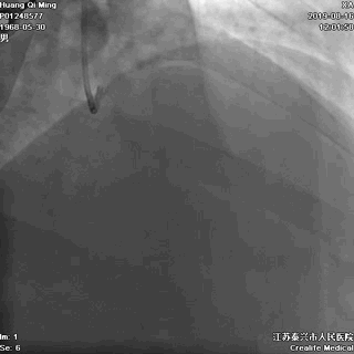 耿宝玉：CCTA指导左冠前降支无植入介入操作一例 -- 严道医声网