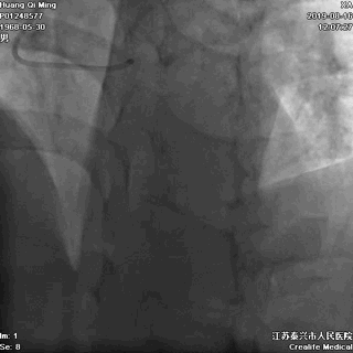 耿宝玉：CCTA指导左冠前降支无植入介入操作一例 -- 严道医声网