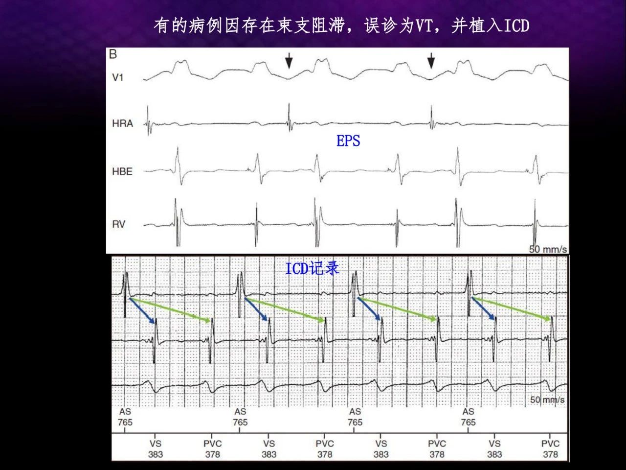 波士顿科学“心律失常实战训练营”实战病例二 总结 -- 严道医声网