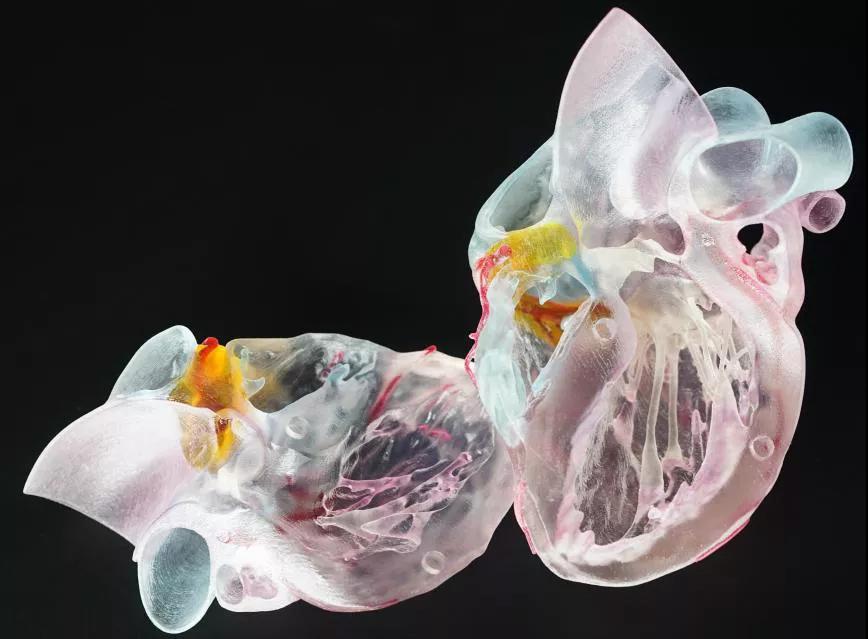 携手同创- 3D打印心脏模型并肩全球首创LuX-Valve®确保三尖瓣置换术安全有效 -- 严道医声网