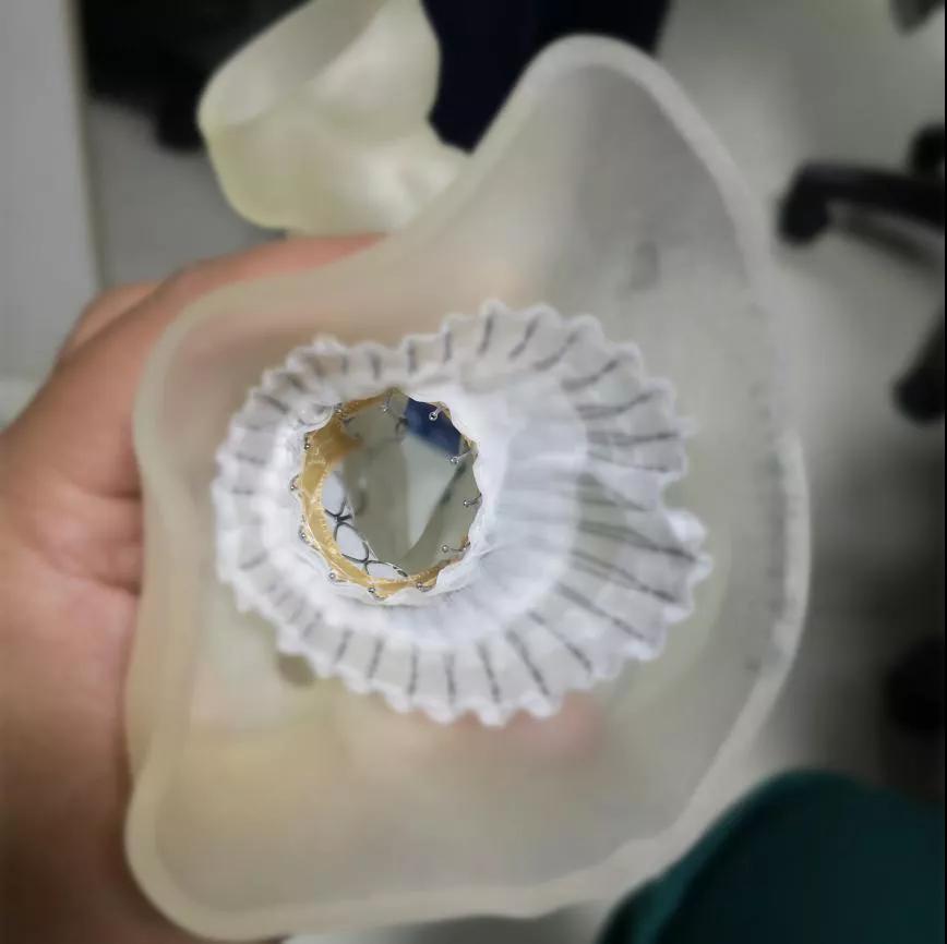 携手同创- 3D打印心脏模型并肩全球首创LuX-Valve®确保三尖瓣置换术安全有效 -- 严道医声网