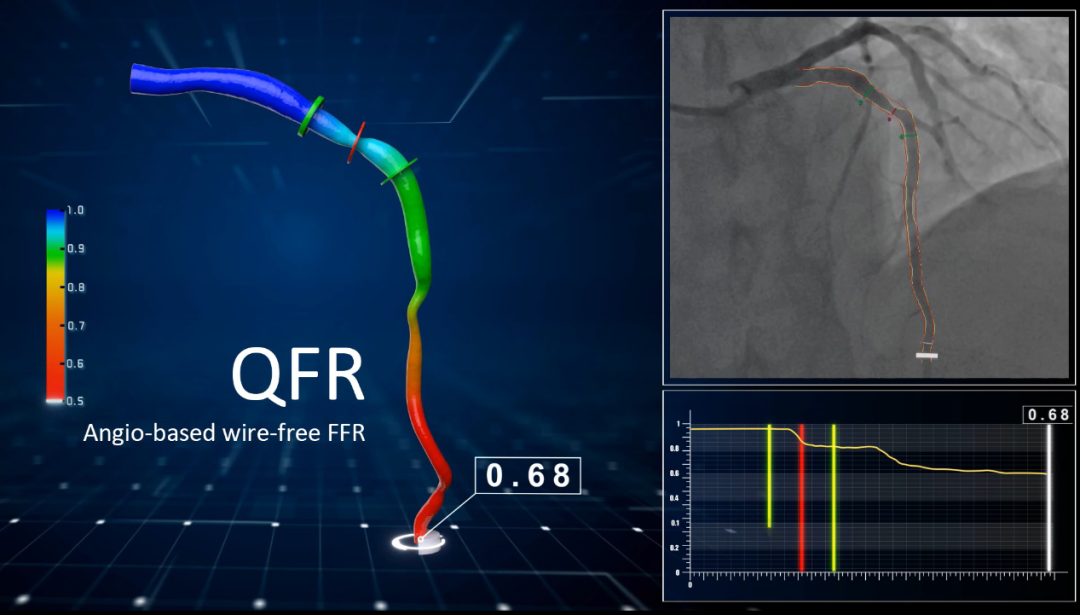 学术丨天坛医院金泽宁、阜外医院徐波等：以QFR为评估标准，药球治疗小血管病变疗效非劣效于DES -- 严道医声网