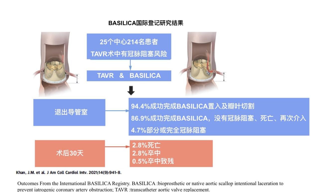 文献速递 | BASILICA用于预防TAVR冠脉阻塞 -- 严道医声网
