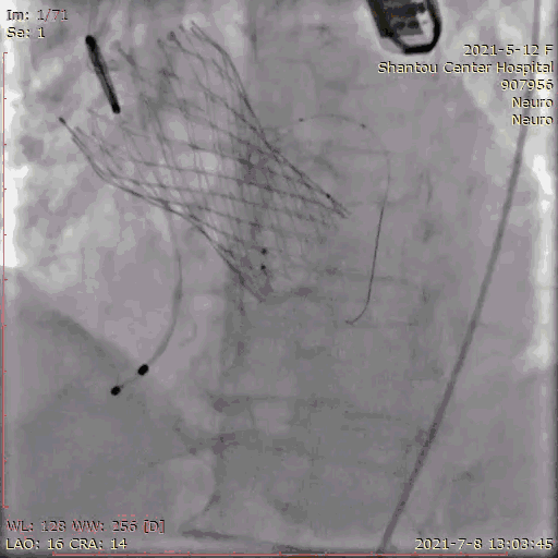 TAVR可回收时代｜汕头市中心医院心外科成功完成4例TAVR手术 -- 严道医声网