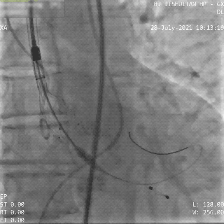北京积水潭医院刘巍教授团队应用VenusA-Plus挑战高难度TAVR手术，成功为两名主狭患者解决“心”头难题 -- 严道医声网