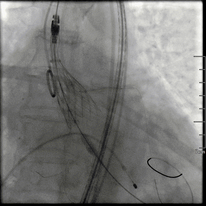 梧州市工人医院中心心血管内科何国欢主任团队顺利完成，极重度狭窄，多处钙化多种复杂病变，首例VitaFlow®瓣膜植入 -- 严道医声网