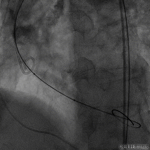 全球首例！四川大学华西医院陈茂教授团队完成全球首款全释放可回收自膨干瓣Venus-PowerX临床应用 -- 严道医声网