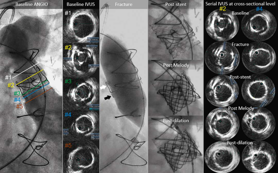 严道资讯｜EuroIntervention和 CARDIOLOGY Journal分别首次报道IVUS用于经导管肺动脉瓣置换病例 -- 严道医声网