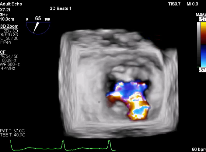 稳扎稳打：安贞医院心脏瓣膜病介入中心完成一例AS合并钙化复杂冠心病行一站式TAVR+旋磨后PCI术及一例FMR行TEER术 -- 严道医声网