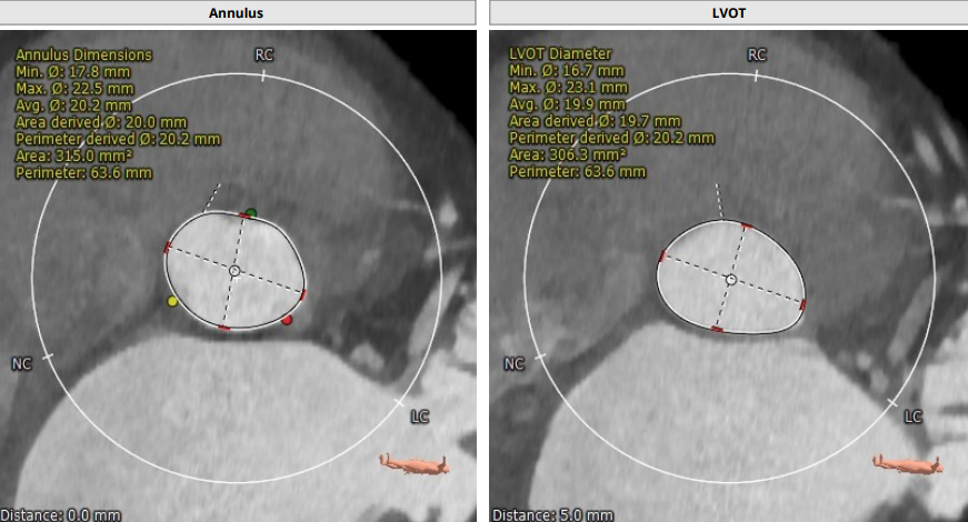 江西省首例！南昌大学第一附属医院应用VenusA-Plus完成Emboshield Nav6抗栓塞远端保护装置下TAVR手术 -- 严道医声网