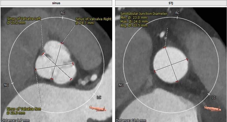江西省首例！南昌大学第一附属医院应用VenusA-Plus完成Emboshield Nav6抗栓塞远端保护装置下TAVR手术 -- 严道医声网