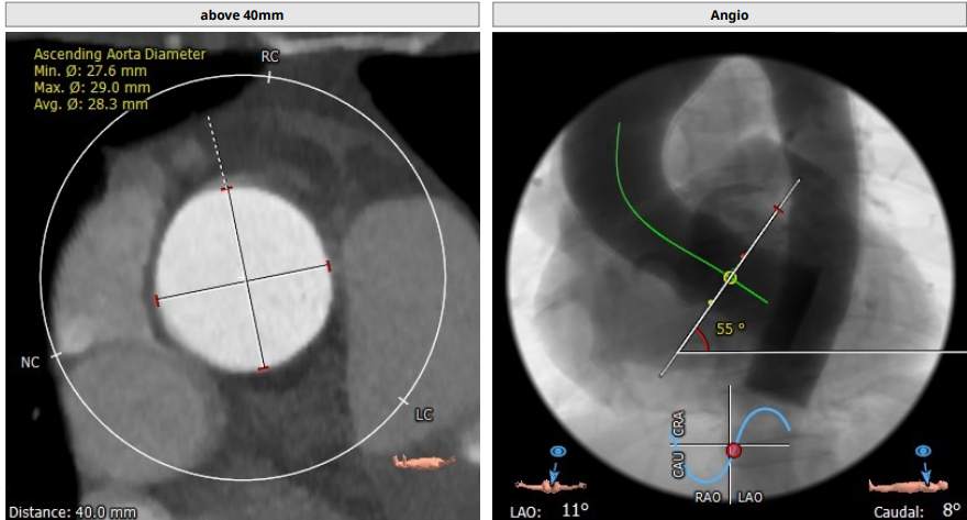 江西省首例！南昌大学第一附属医院应用VenusA-Plus完成Emboshield Nav6抗栓塞远端保护装置下TAVR手术 -- 严道医声网