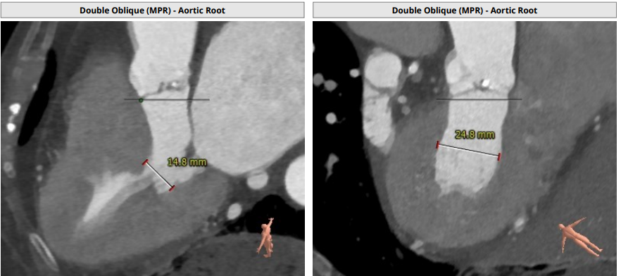 江西省首例！南昌大学第一附属医院应用VenusA-Plus完成Emboshield Nav6抗栓塞远端保护装置下TAVR手术 -- 严道医声网