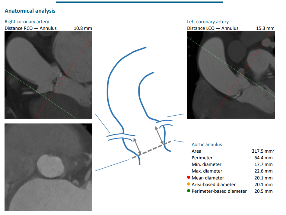 江西省首例！南昌大学第一附属医院应用VenusA-Plus完成Emboshield Nav6抗栓塞远端保护装置下TAVR手术 -- 严道医声网