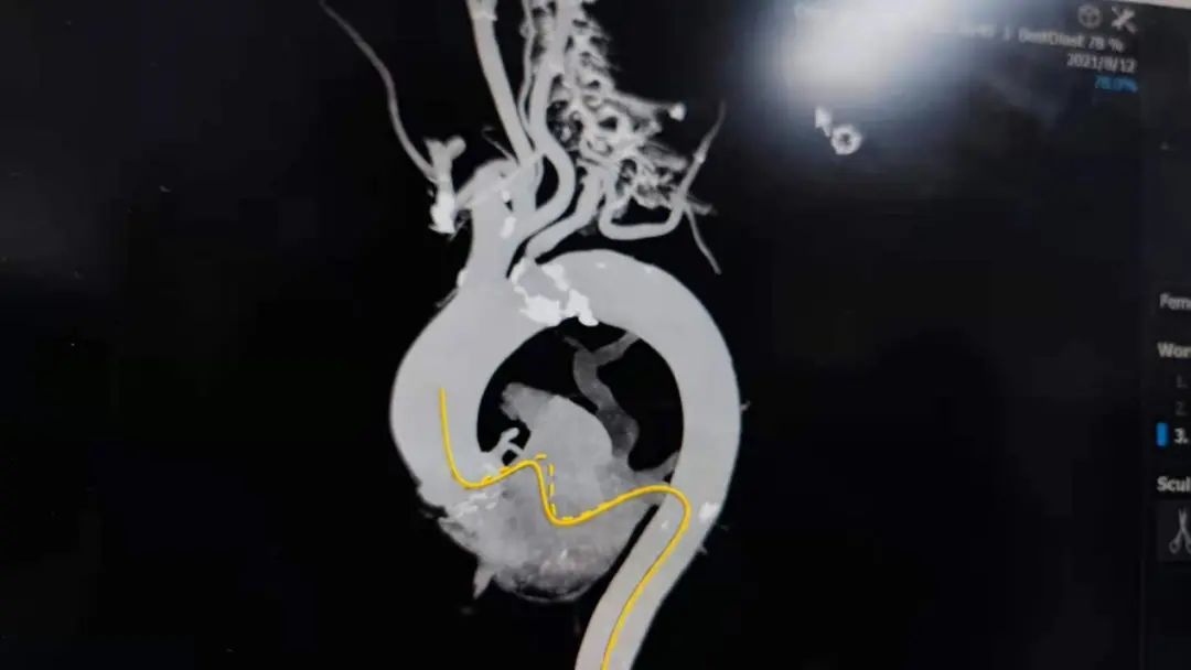 江西省首例！南昌大学第一附属医院应用VenusA-Plus完成Emboshield Nav6抗栓塞远端保护装置下TAVR手术 -- 严道医声网