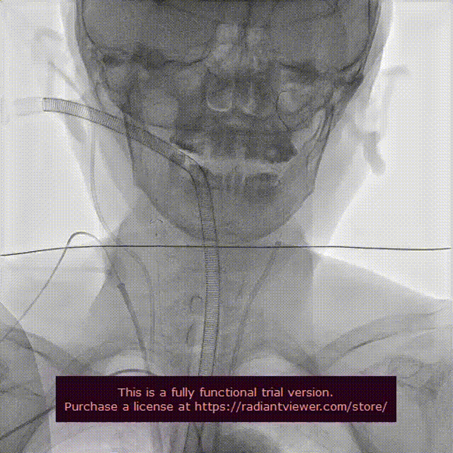 江西省首例！南昌大学第一附属医院应用VenusA-Plus完成Emboshield Nav6抗栓塞远端保护装置下TAVR手术 -- 严道医声网