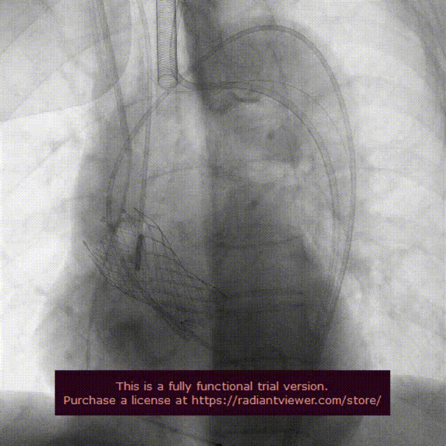江西省首例！南昌大学第一附属医院应用VenusA-Plus完成Emboshield Nav6抗栓塞远端保护装置下TAVR手术 -- 严道医声网