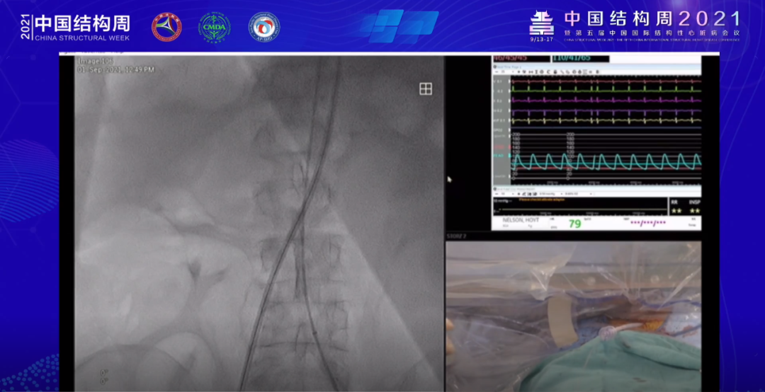 中国结构周2021亮点速递丨超声引导下经皮腋动脉TAVR创新手术形式，经腔静脉入路TAVR手术全流程操作国内首播，震撼四座！ -- 严道医声网
