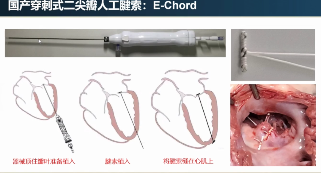 中国结构周2021｜国际频道第四日回归TAVR经典话题，共话复杂TAVR的现在与未来 -- 严道医声网