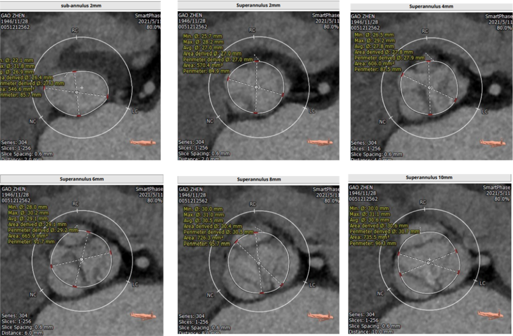 安贞医院瓣膜病介入中心利用国产器械在国内首次开展TAVR+TEER微创治疗联合瓣膜反流 -- 严道医声网