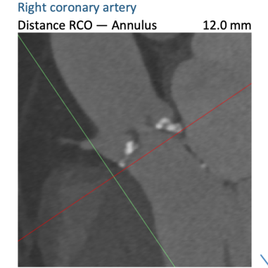 算无遗策｜新疆自治区人民医院杨毅宁教授团队运用Feops&VenusA-Plus完成两台高难度TAVR手术 -- 严道医声网