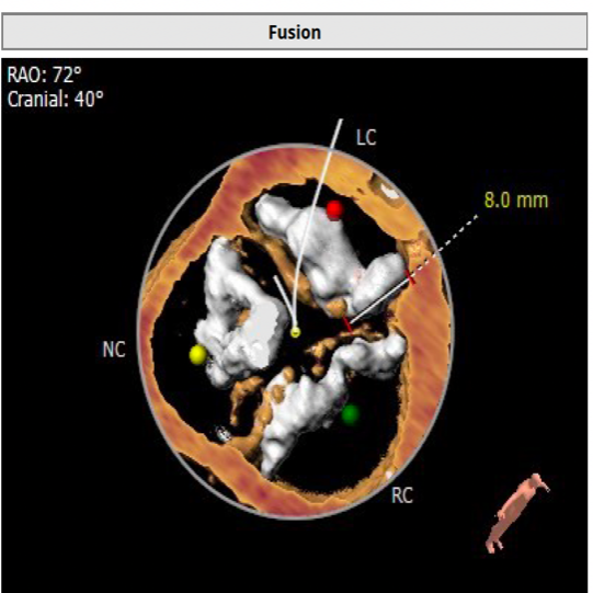 全球首例！董念国、吴永健、彭小平教授三方团队成功完成Leaflex™ Performer联合TriGUARD3™人体应用 -- 严道医声网