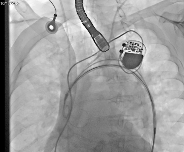 全球首例！董念国、吴永健、彭小平教授三方团队成功完成Leaflex™ Performer联合TriGUARD3™人体应用 -- 严道医声网