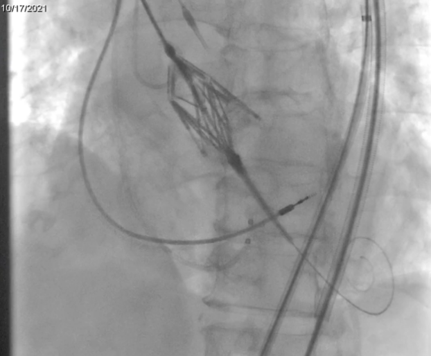 全球首例！董念国、吴永健、彭小平教授三方团队成功完成Leaflex™ Performer联合TriGUARD3™人体应用 -- 严道医声网