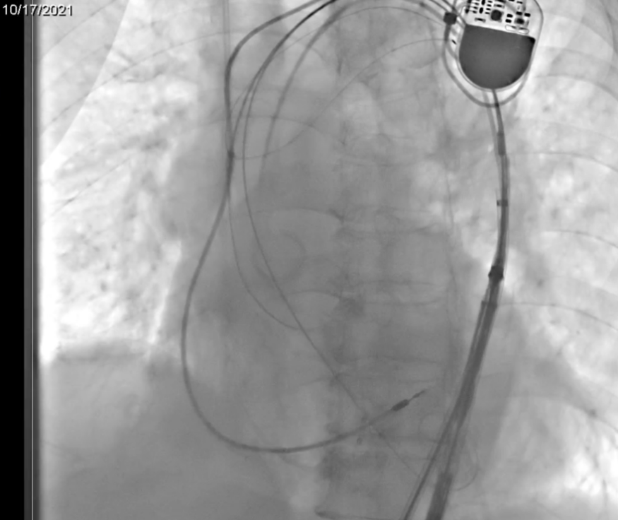 全球首例！董念国、吴永健、彭小平教授三方团队成功完成Leaflex™ Performer联合TriGUARD3™人体应用 -- 严道医声网