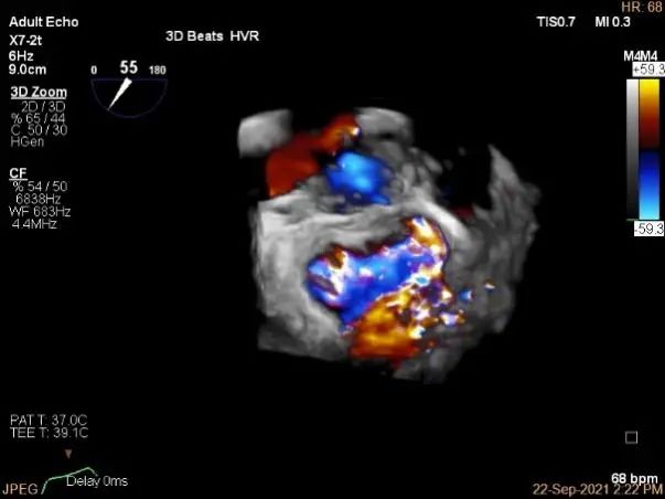 “贞”心一“课”｜一例P1接近交界区重度MR患者TEER手术 -- 严道医声网