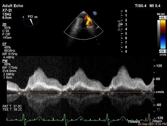“贞”心一“课”｜一例P1接近交界区重度MR患者TEER手术 -- 严道医声网