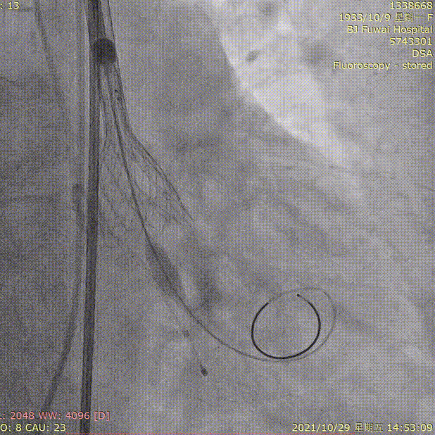 GW-ICC/AHS.21│吴永健教授转播高龄患者完全局麻无镇静极简式TAVR一例 -- 严道医声网