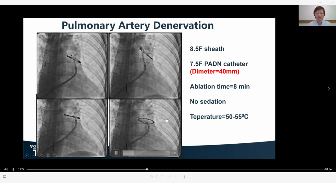 TCT 2021丨Gregg W.Stone领衔帕母医疗开启肺高压Global Trial，共迎肺高压介入治疗新纪元 -- 严道医声网