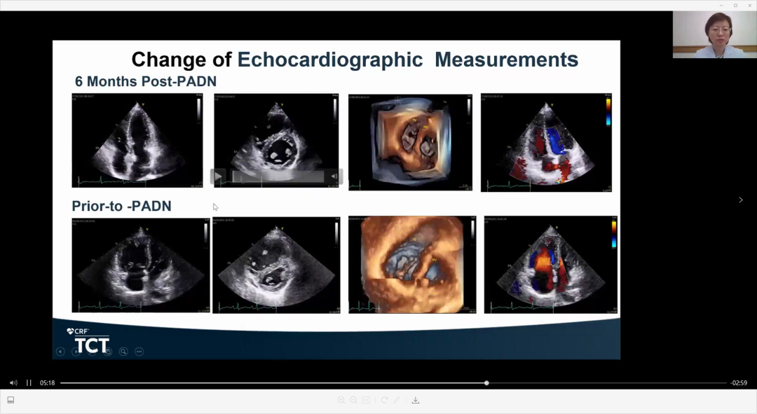 TCT 2021丨Gregg W.Stone领衔帕母医疗开启肺高压Global Trial，共迎肺高压介入治疗新纪元 -- 严道医声网
