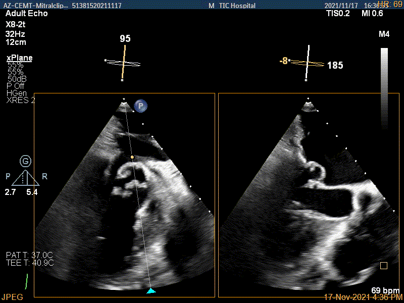 “贞”心一“课”｜P1区+前交界大脱垂TEER治疗1例 -- 严道医声网