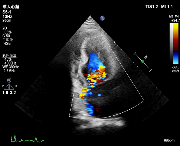 “贞”心一“课”｜P1区+前交界大脱垂TEER治疗1例 -- 严道医声网