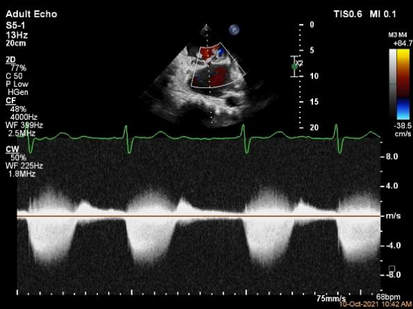 “贞”心一“课”｜A1、A2区Flail+巨大心房的TEER治疗1例 -- 严道医声网