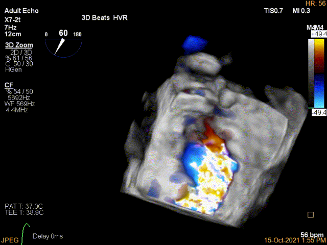 “贞”心一“课”｜A1、A2区Flail+巨大心房的TEER治疗1例 -- 严道医声网