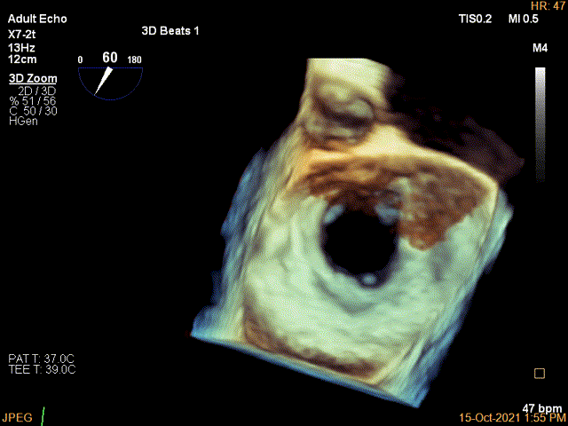 “贞”心一“课”｜A1、A2区Flail+巨大心房的TEER治疗1例 -- 严道医声网