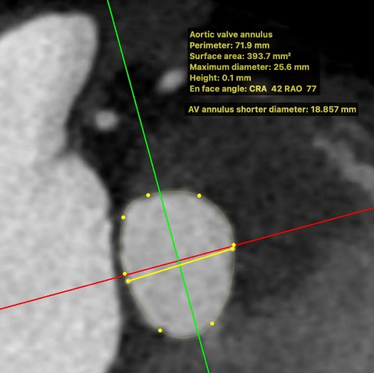 全球首例！四川大学华西医院陈茂教授团队完成全球首款全释放可回收自膨干瓣Venus-PowerX临床应用 -- 严道医声网