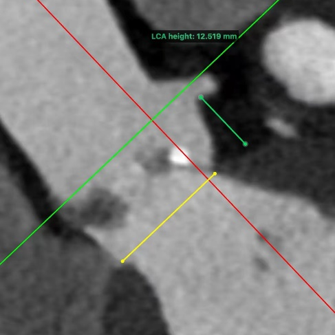 全球首例！四川大学华西医院陈茂教授团队完成全球首款全释放可回收自膨干瓣Venus-PowerX临床应用 -- 严道医声网