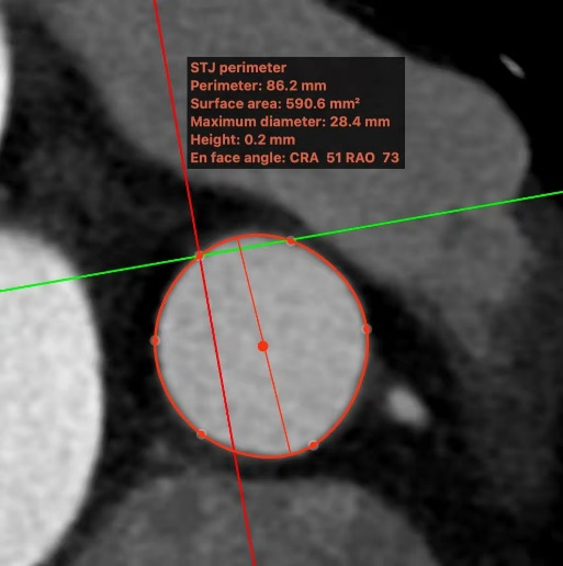 全球首例！四川大学华西医院陈茂教授团队完成全球首款全释放可回收自膨干瓣Venus-PowerX临床应用 -- 严道医声网